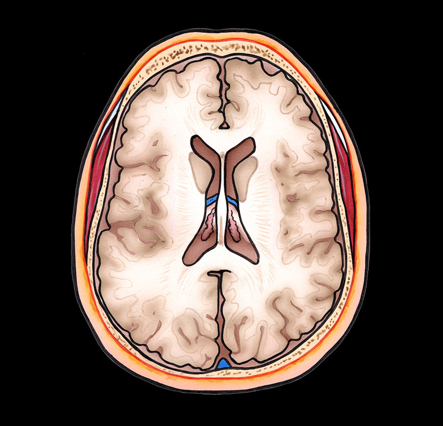Inferior Parietal Lobule Radiology