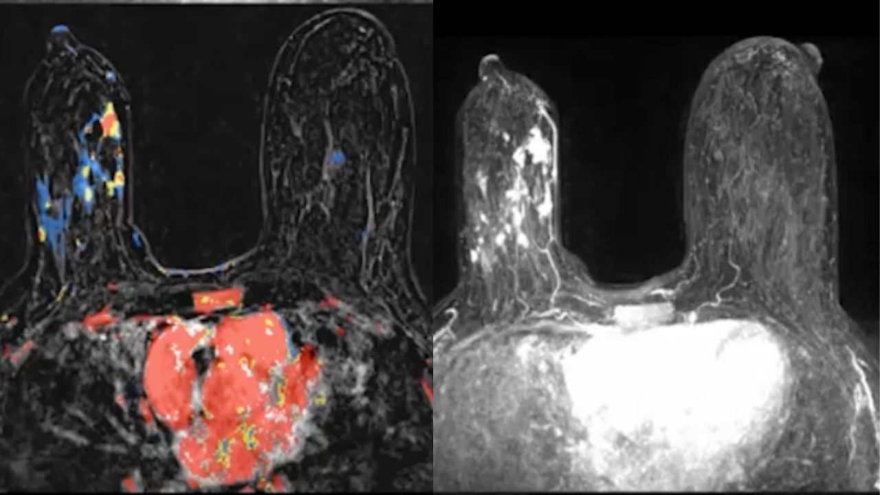 Avoiding Mistakes & Managing Complications in Breast Imaging Expert ...
