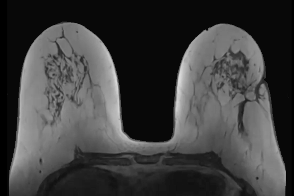 BI-RADS 3 – Introduction - Medality / MRI Online