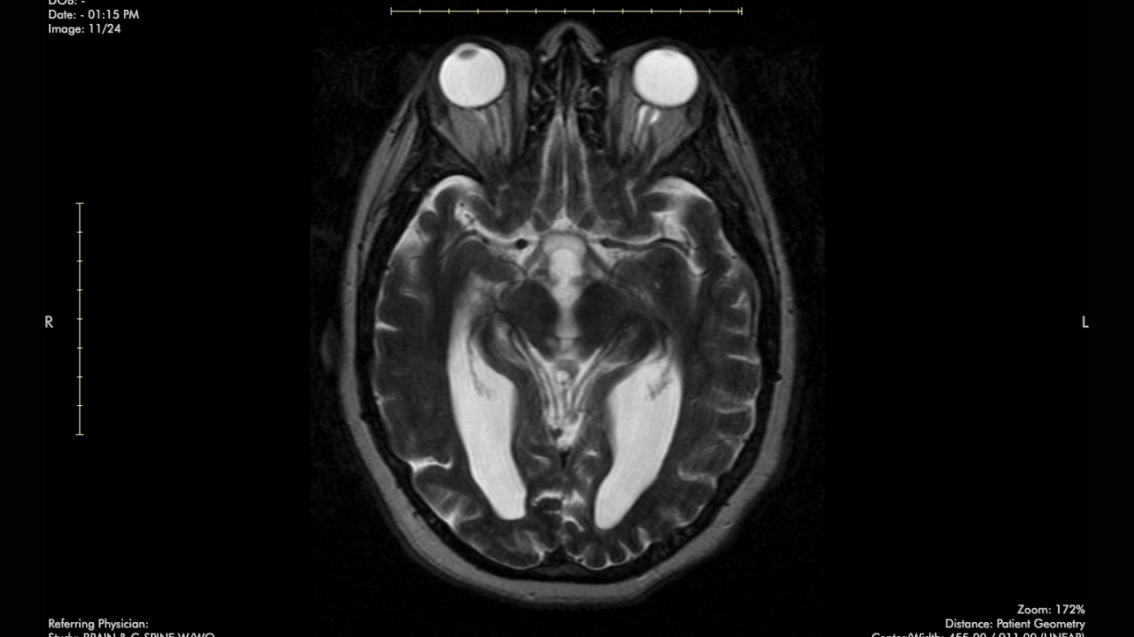 Case 10 - 58-year-old male case is a followup for supratentorial tumor ...