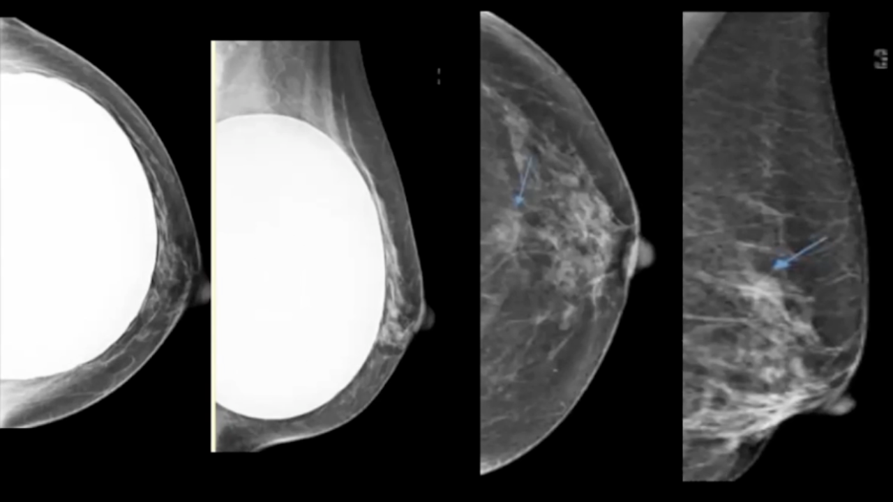 Breast Implant Associated Cancer - MRI Online is now Medality
