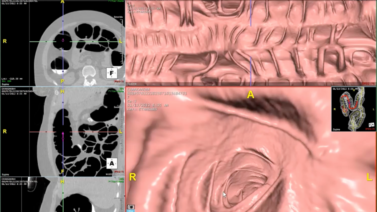 Evolution of CT Colonography - MRI Online is now Medality