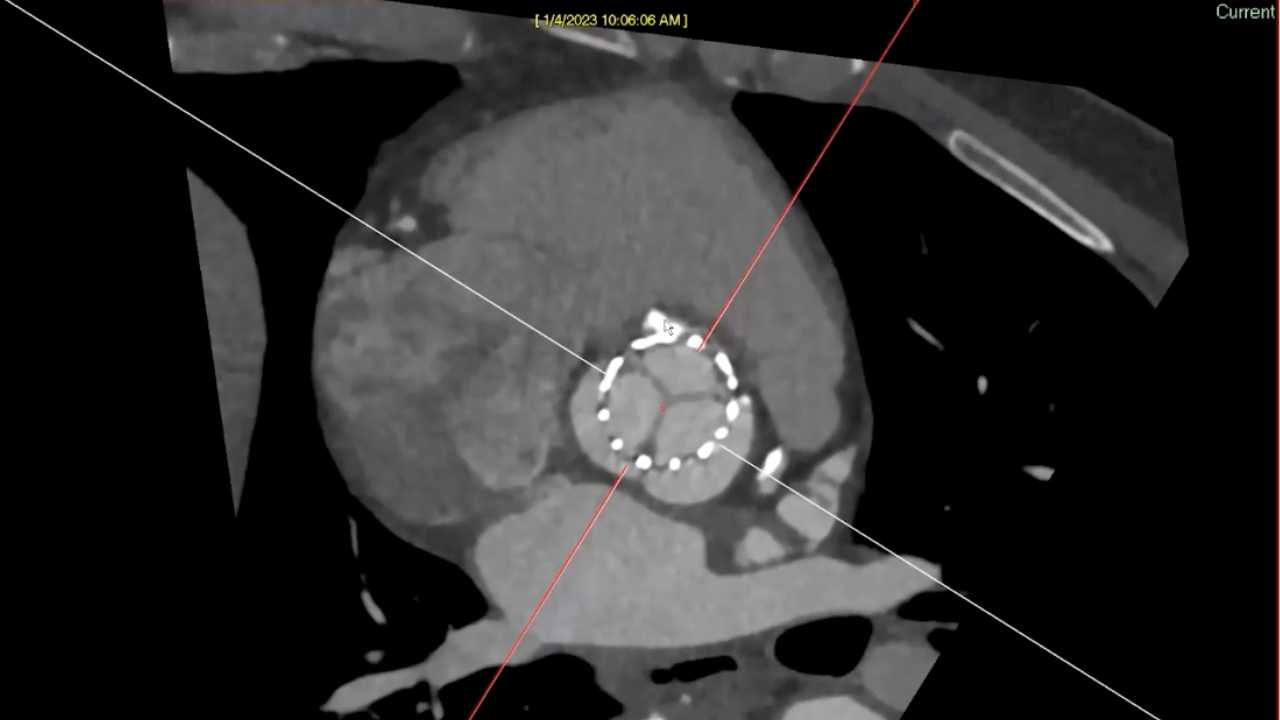 Aortic Valve Calcium Scoring Case Review - MRI Online is now Medality