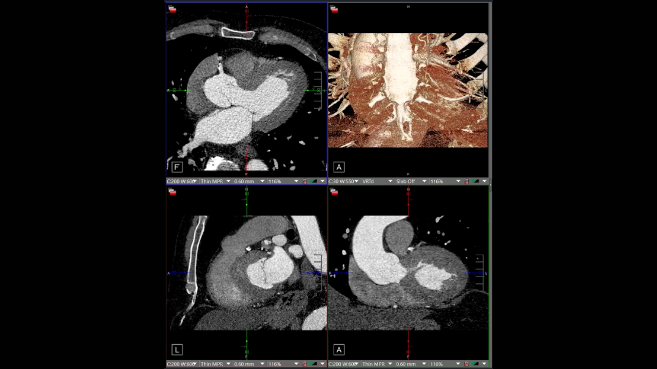Cardiac CT in Ischemic Heart Disease, Known CAD - Radiology Course ...