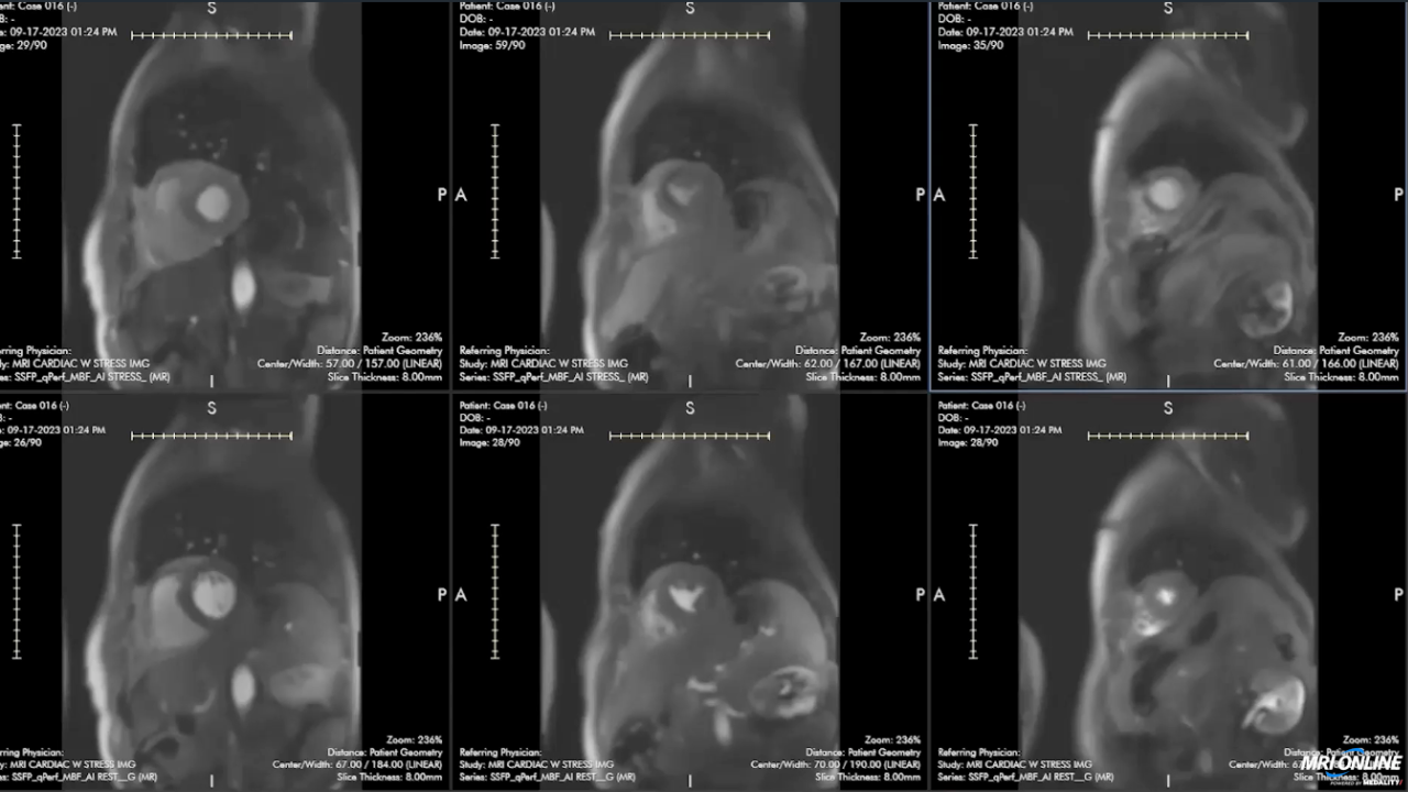 Transmural, Non-transmural, RCA Infarct - MRI Online is now Medality