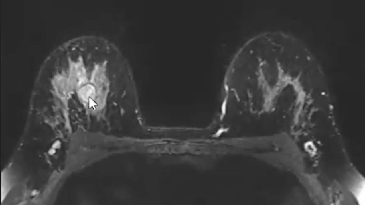 Challenging Breast Cases - Case 1 - MRI Online is now Medality