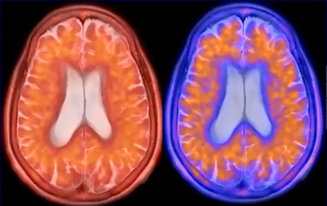 Amyloid Related Imaging Abnormalities (ARIA) - MRI Online is now Medality