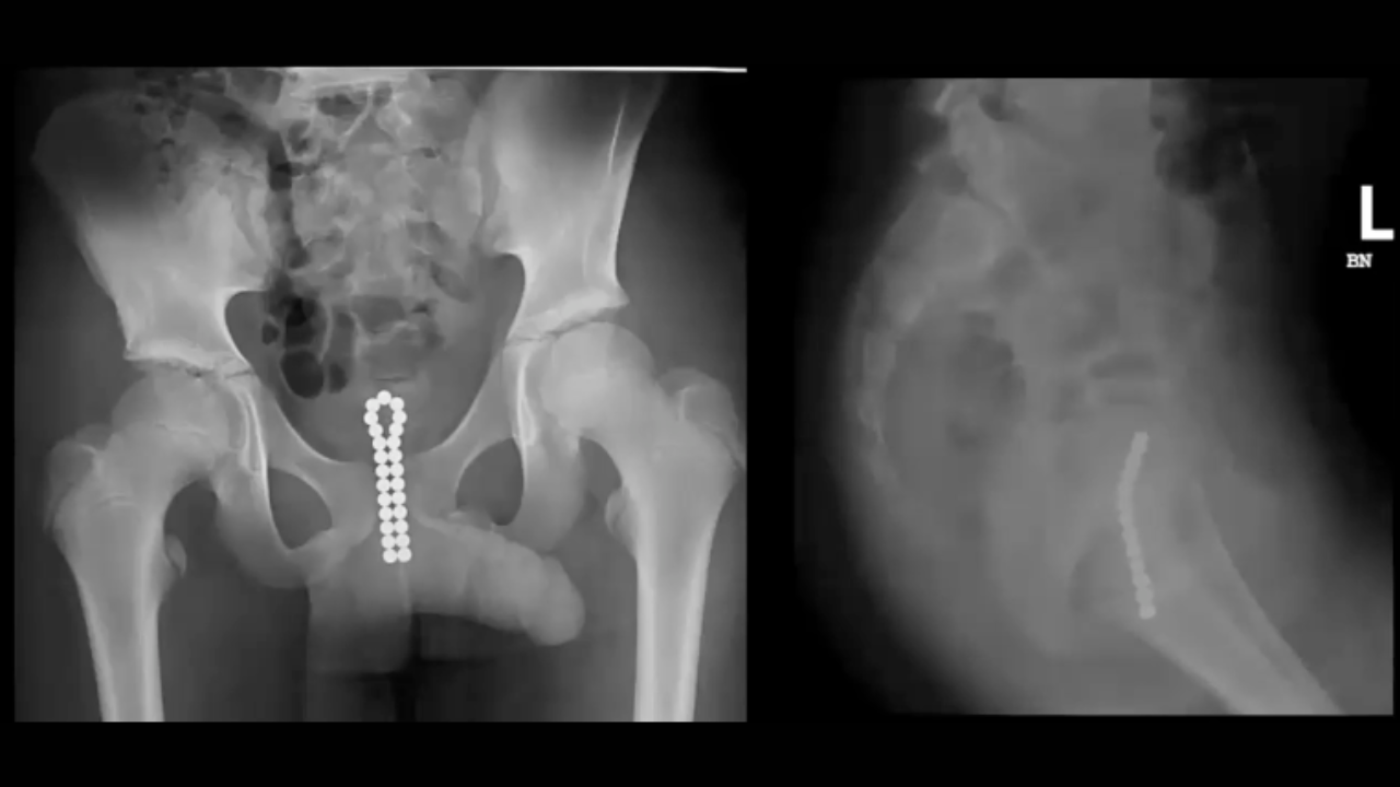 CT Evaluation of Pelvic Ring Injuries - Patterns, Classifications, and ...