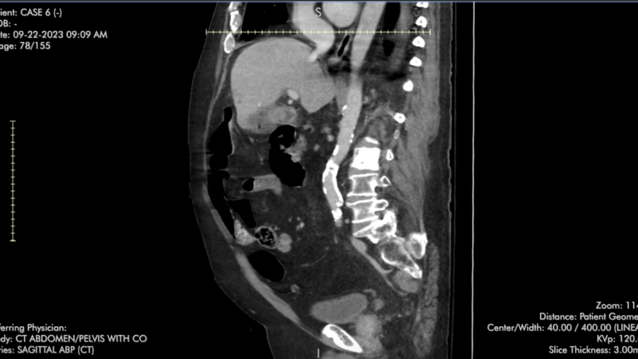 Case 14 - 62-year-old female with two days of right flank pain, nausea ...