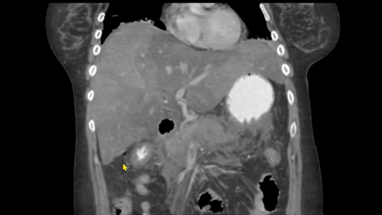 Case: Large Bowel Colonic Obstruction - MRI Online is now Medality