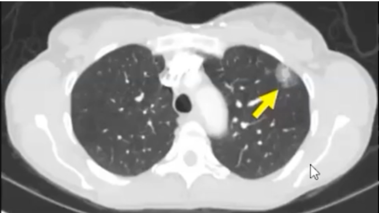 Evaluation of Pulmonary Nodules and Lung Cancers (CT & PET/CT ...
