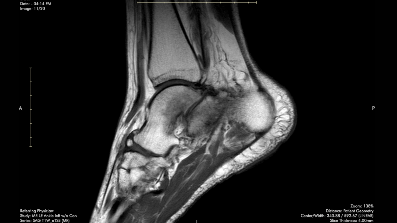 Case 20 - 68-year-old female presents with right midfoot pain - MRI ...