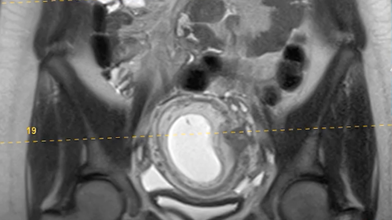 Percreta with Bladder Invasion - MRI Online is now Medality