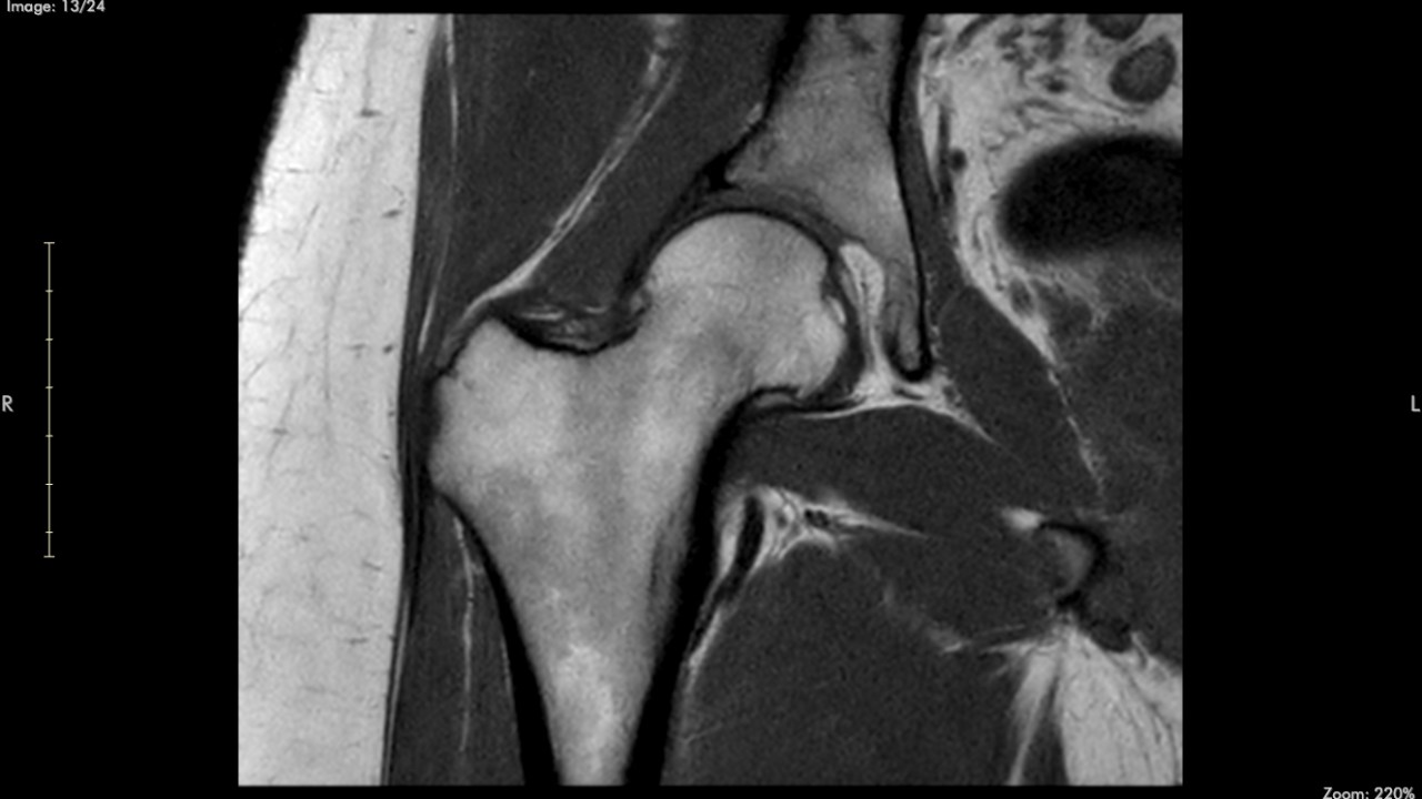 Hip MRI Proficiency Practice Cases - Radiology Course - MRI Online is ...