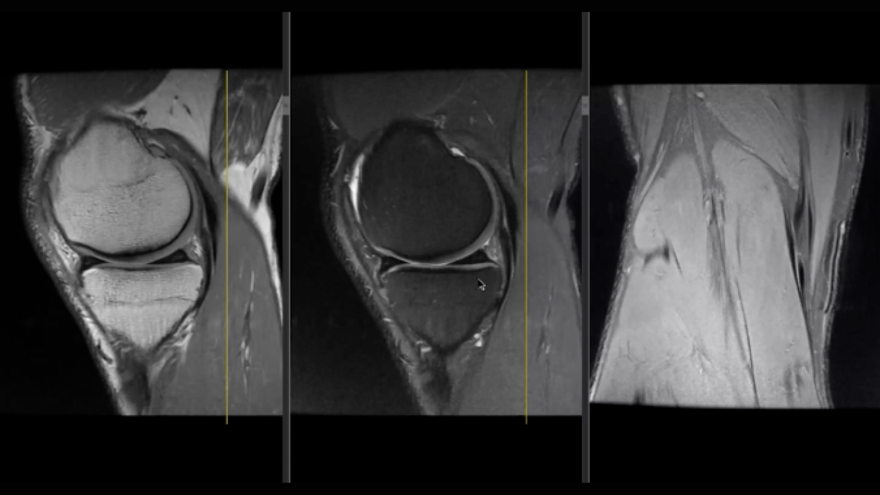Wrisberg Rip & Ligament of Humphrey Tear - MRI Online is now Medality