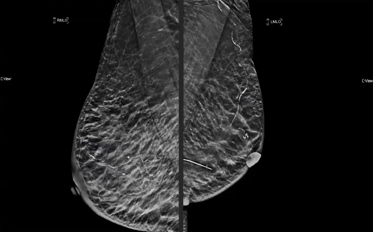 Breast MRI Case 10 - MRI Online is now Medality