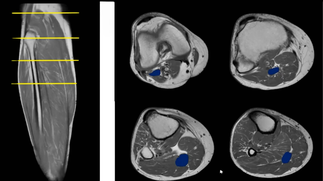 Bone Tumors, Dr. Scott Schiffman (7-20-20) - MRI Online is now Medality
