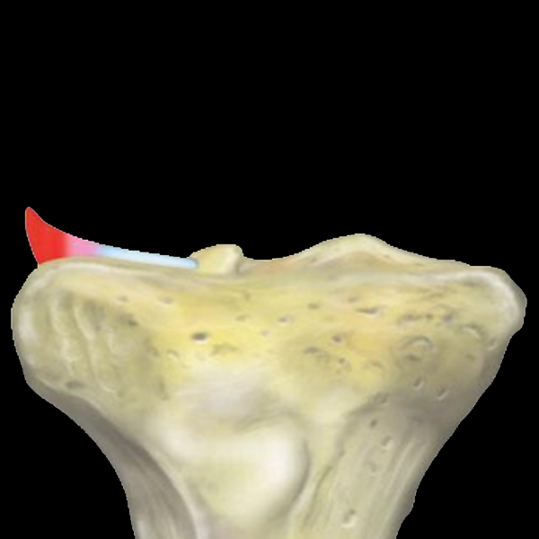 Knee Case Review: Post Meniscectomy Chondromalacia - MRI Online is now ...