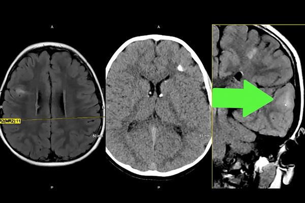 Proper MRI Sequences to Evaluate TSC Lesions - MRI Online is now Medality