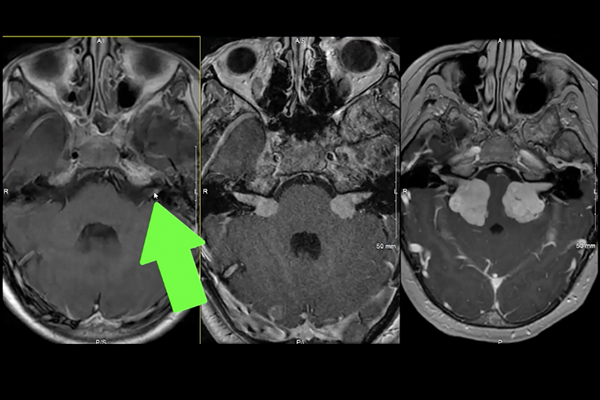 Neurofibromatosis Type 2 (NF2) and Other Neurocutaneous Syndromes ...