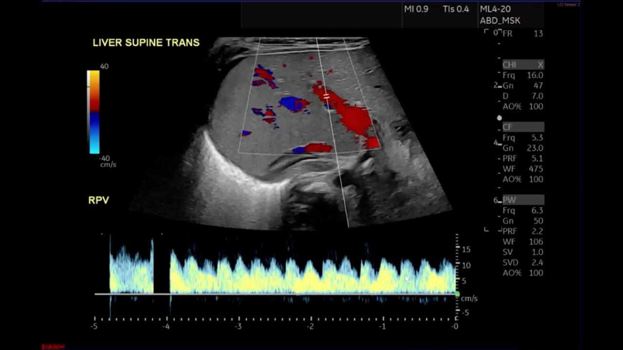 Case: Support Device Complication, UVC Hematoma/tpn-oma - MRI Online is ...