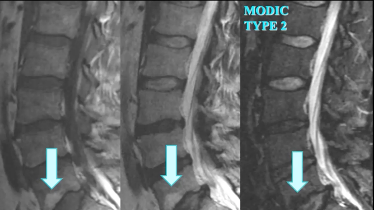 Interpreting Lumbar Spine MRIs - What Findings are Relevant?, Dr. John ...