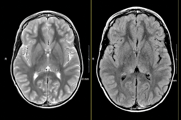 NF1 with Developing Myelin Vacuolization, and Optic Glioma - MRI Online ...