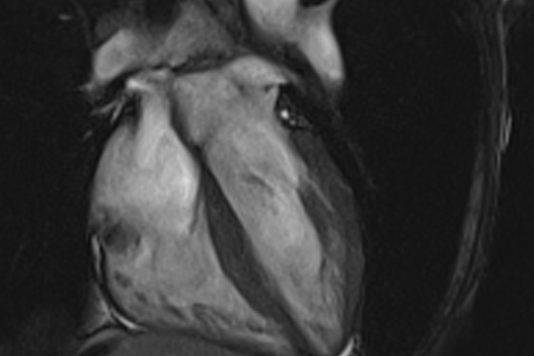 HCM: Basal Septal with SAM - MRI Online is now Medality