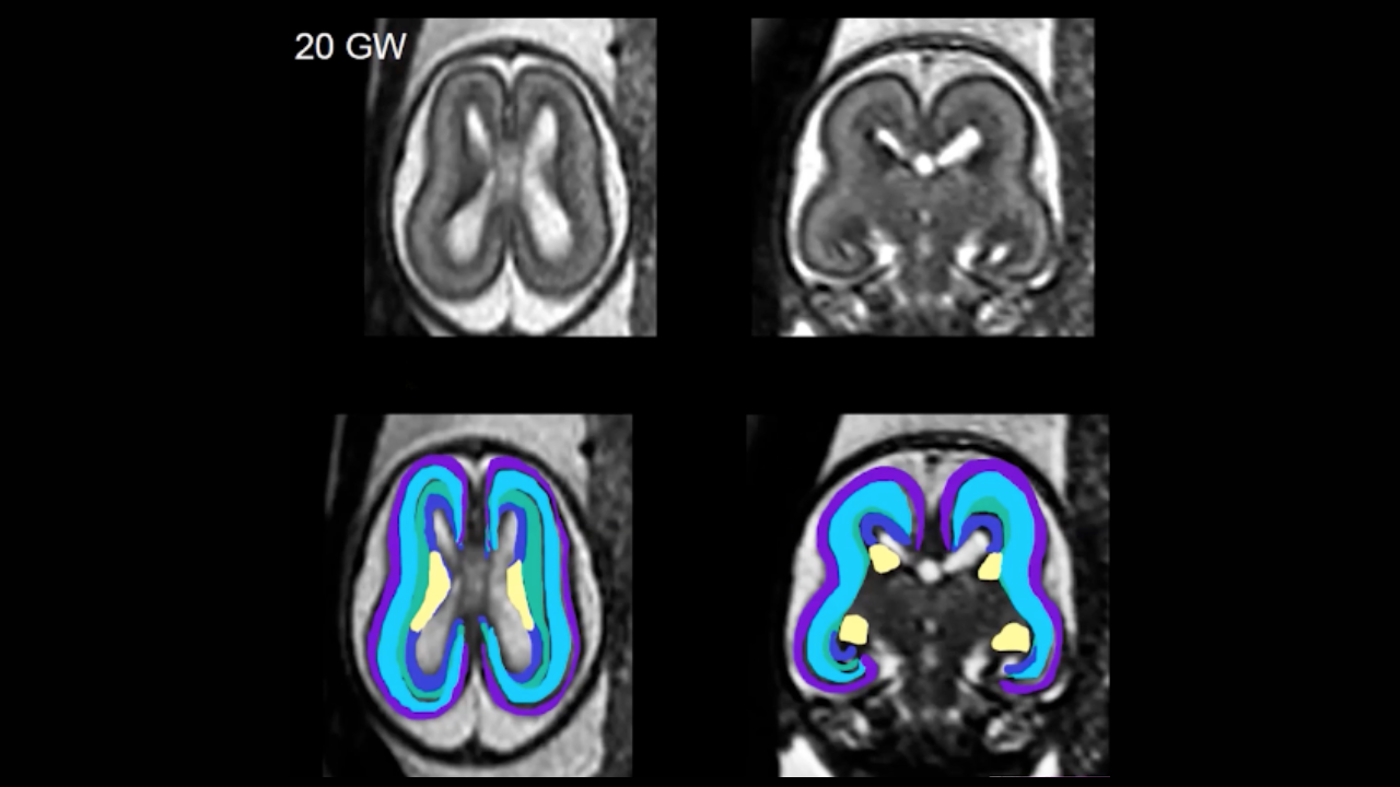The FIGO Classification System for Uterine Fibroids- Review of MRI ...