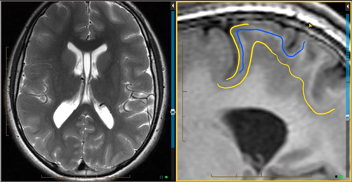 Septo-optic Dysplasia (SOD) - MRI Online is now Medality