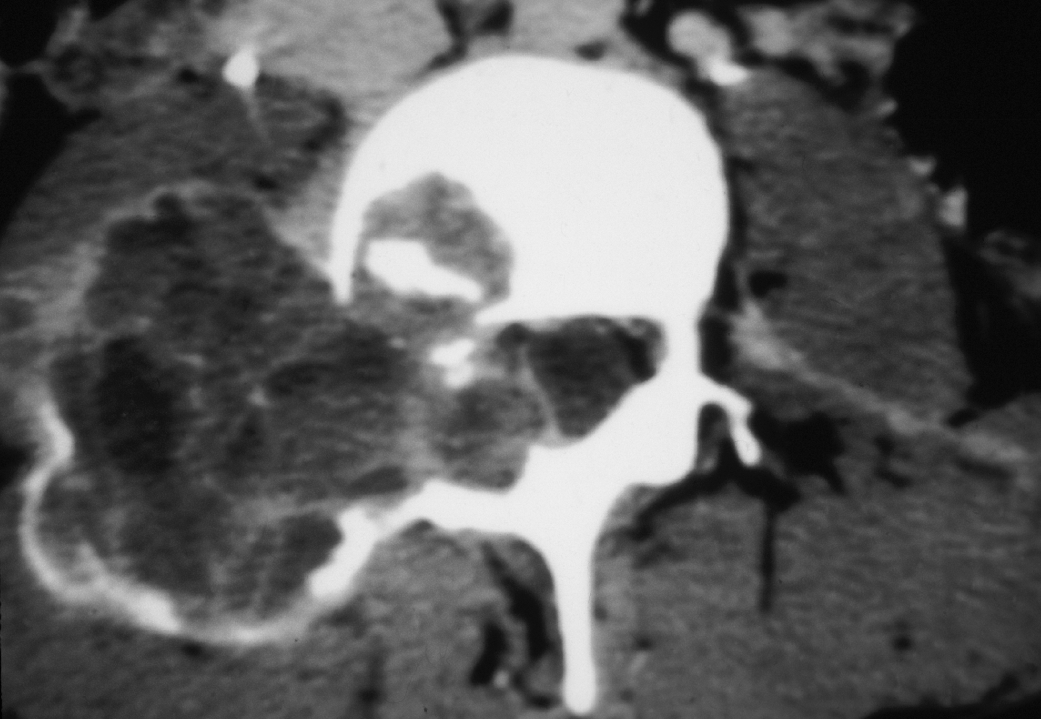 Identifying an Annular Fissure - Medality / MRI Online