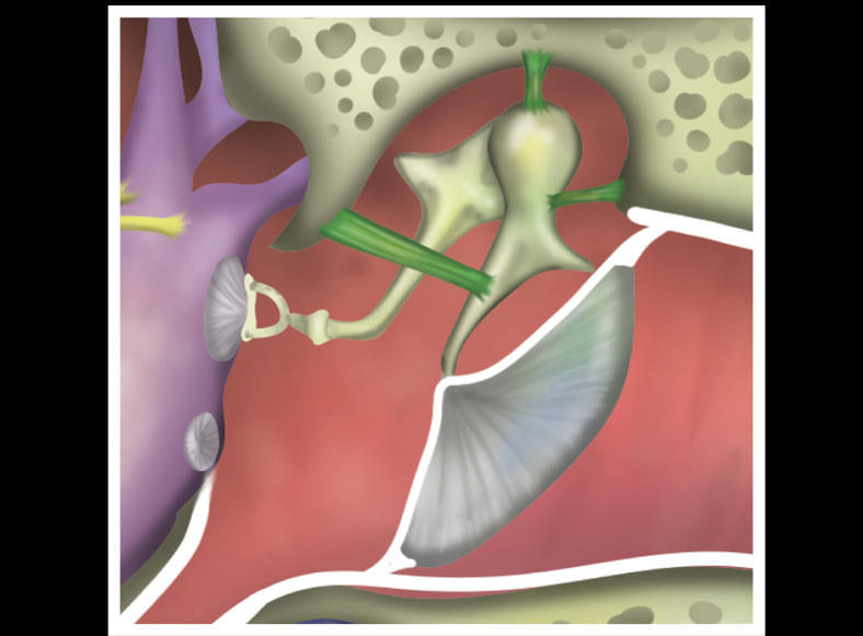 Total Ossicular Replacement Prosthesis (TORP) - MRI Online is now Medality