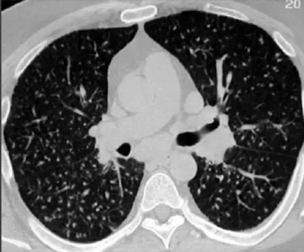 Anatomy of Secondary Pulmonary Lobule - Medality / MRI Online