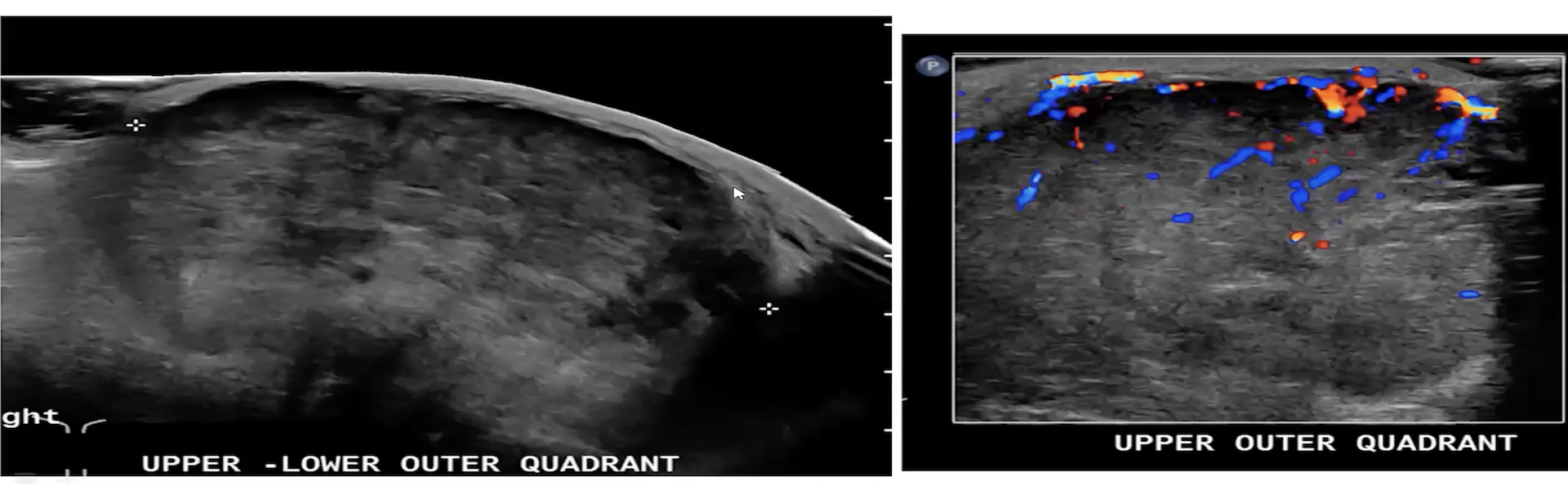 Ductal Carcinoma in Situ (DCIS) - MRI Online is now Medality