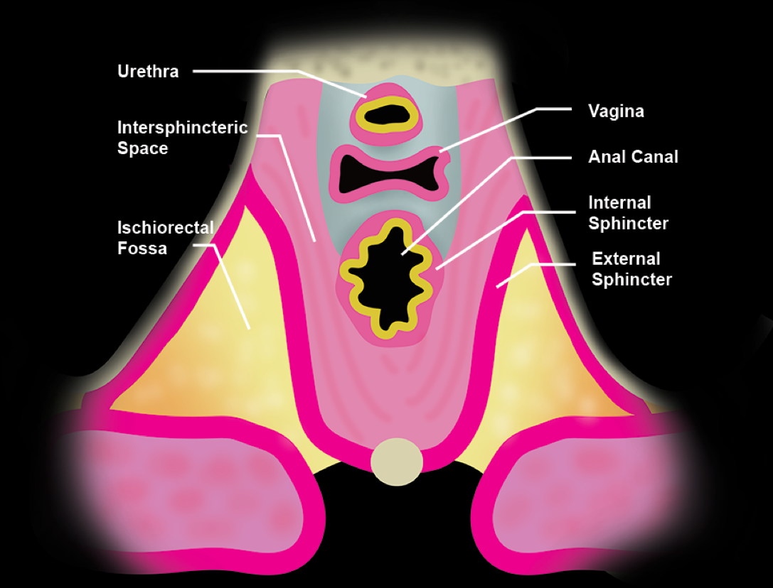 Fistula in a Patient with Bilateral Hip Replacements - MRI Online is ...