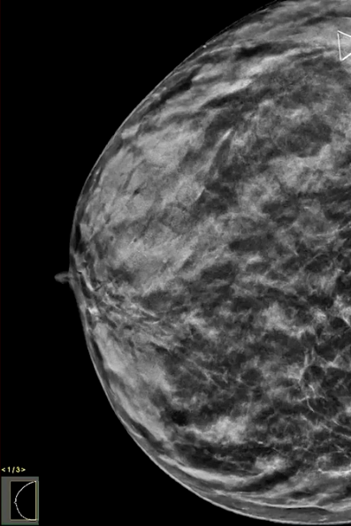 Large Axillary Lymph Node Overview - MRI Online is now Medality