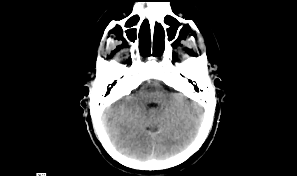 Carotid & Vertebral Artery Dissection Overview & Examples - Medality ...