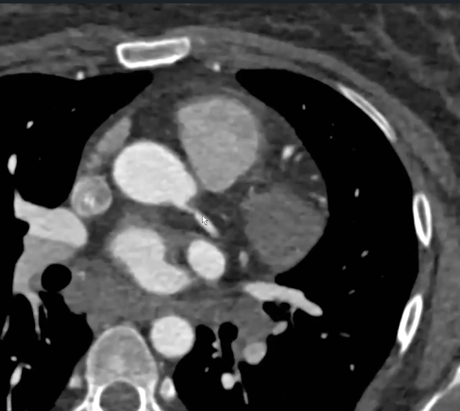 Approach to Reading Coronary CT - Overview of Case Series - Medality ...