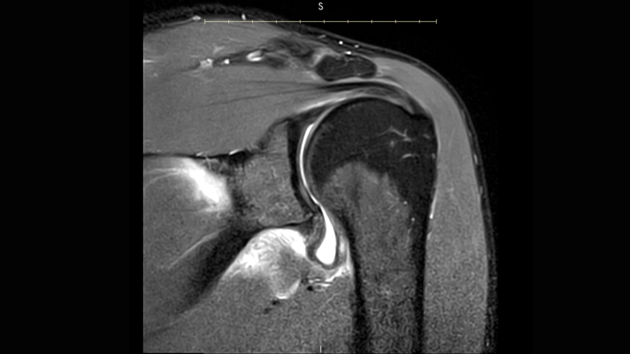 Shoulder MRI Case Challenge 2 - Radiology Course - MRI Online is now ...