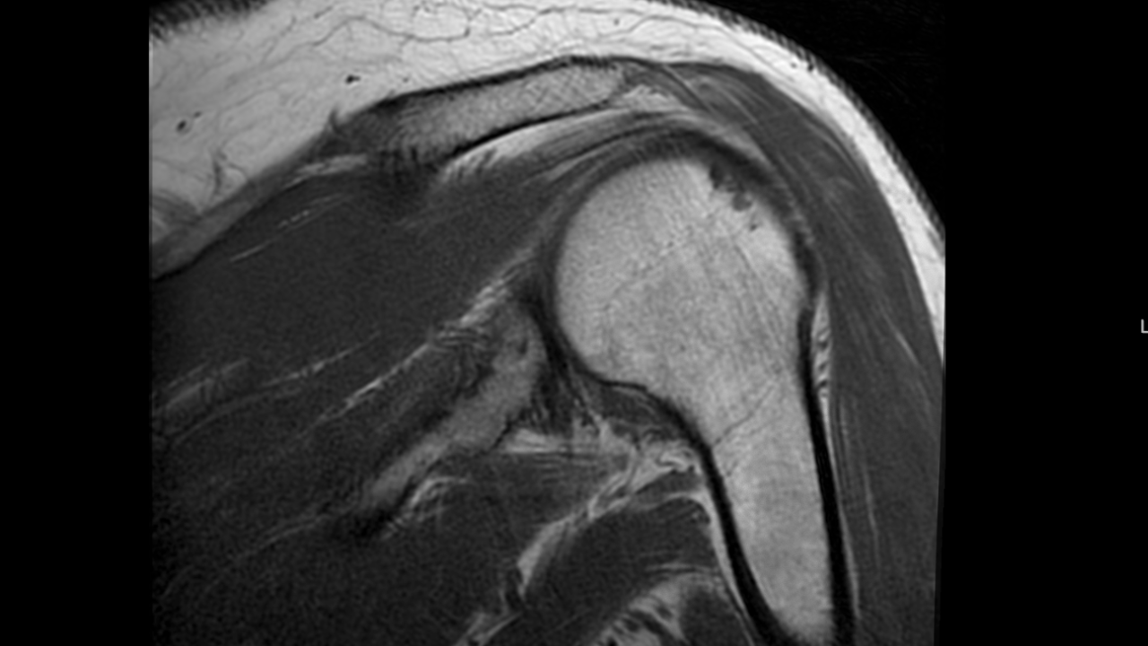 Shoulder Proficiency Practice Cases - Radiology Course - Medality / MRI ...