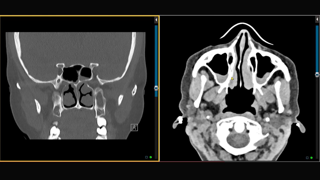 Inverted Papilloma Mri