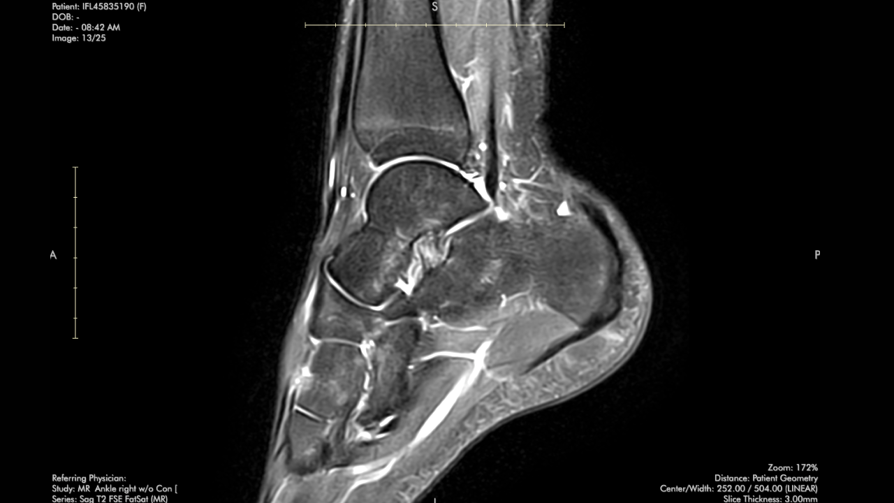 Case 10 - 30 year old male with midfoot pain following twisting injury ...