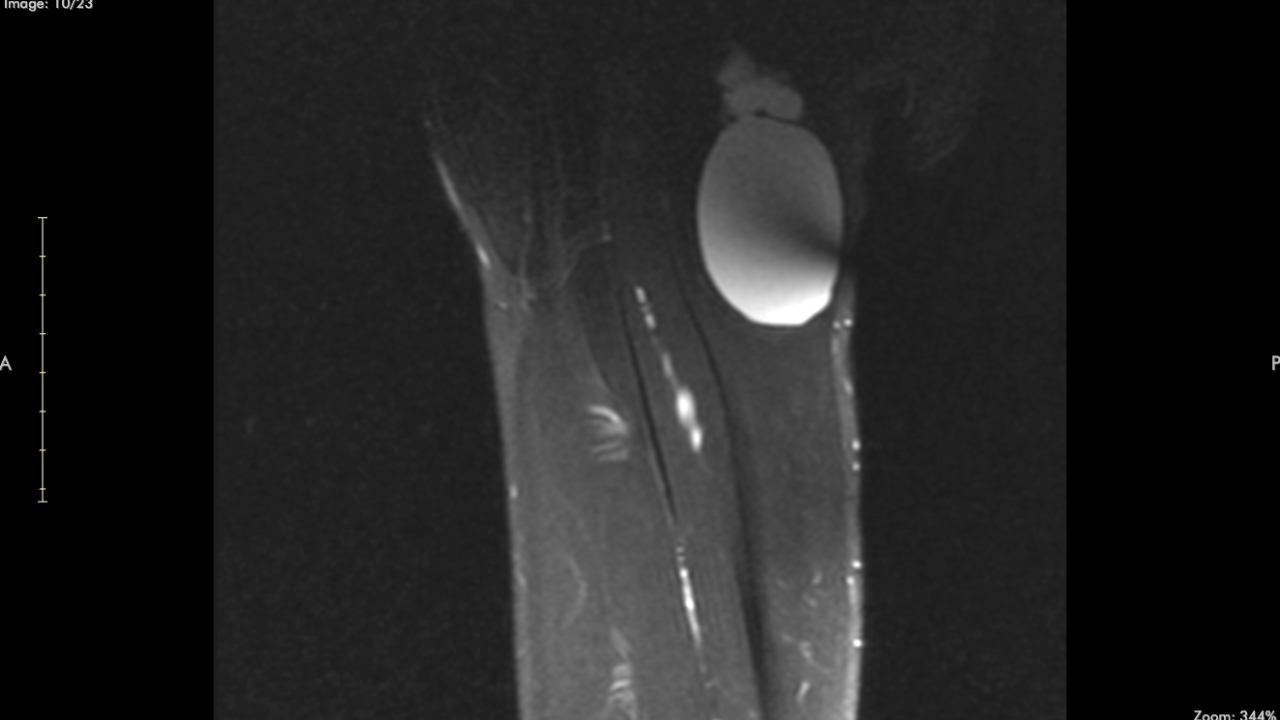 Soft Tissue Masses MRI Cases - Radiology Course - Medality / MRI Online