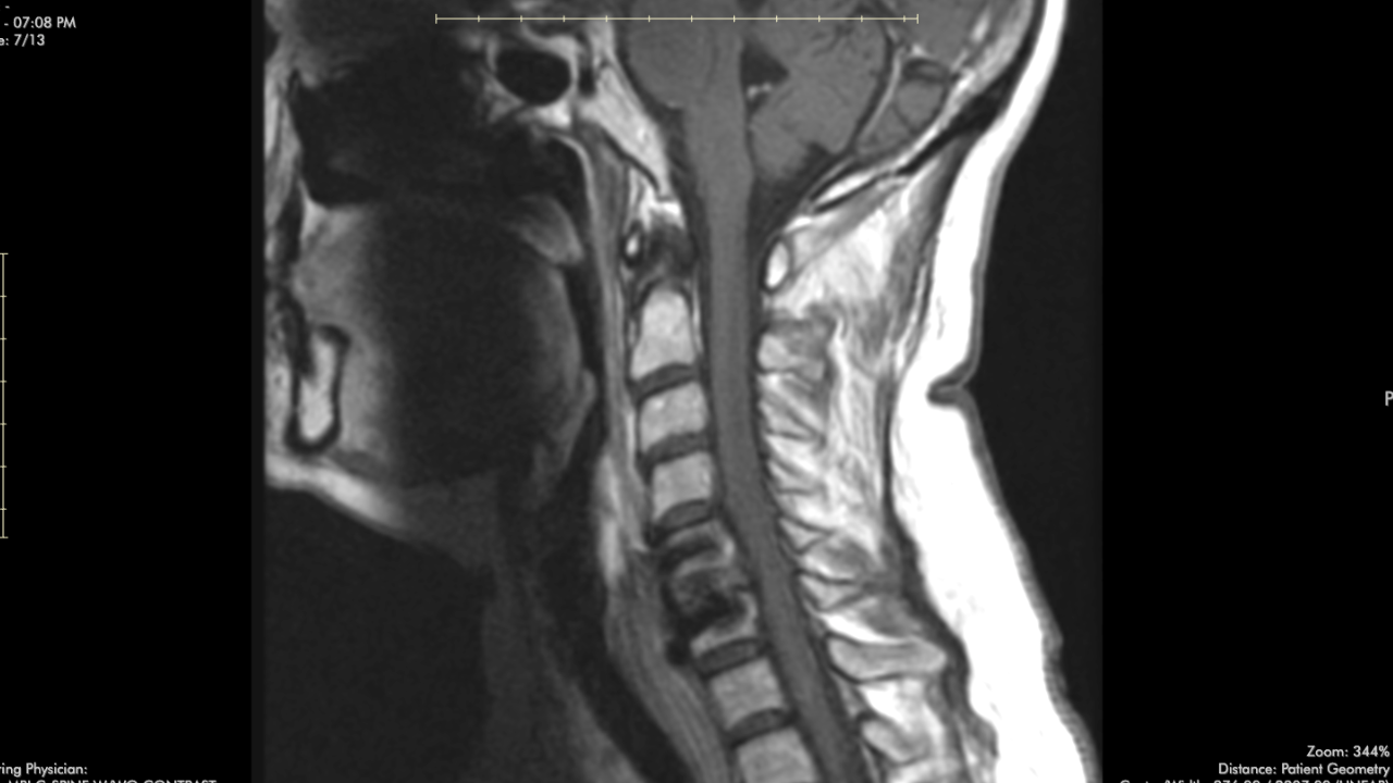 Spine MRI Proficiency Practice Cases - Radiology Course - MRI Online is ...