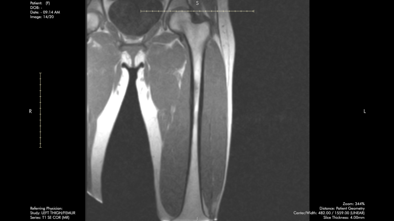 Case 6 - 57-year-old male presents with left thigh strain / muscle ...