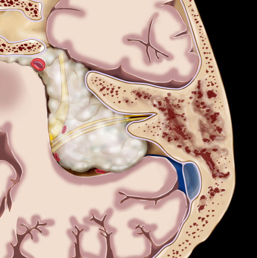 Epidermoid Cyst – Internal Characteristics - MRI Online is now Medality