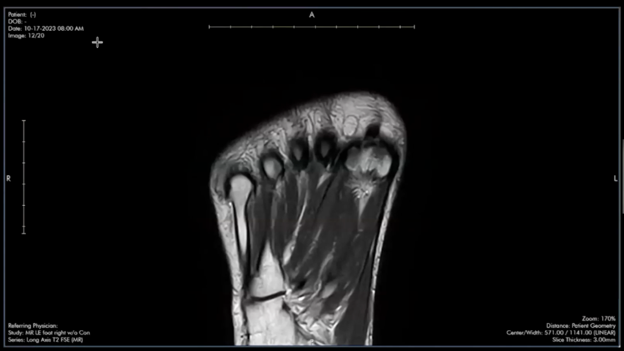 Case 3: Stress Fracture - MRI Online is now Medality