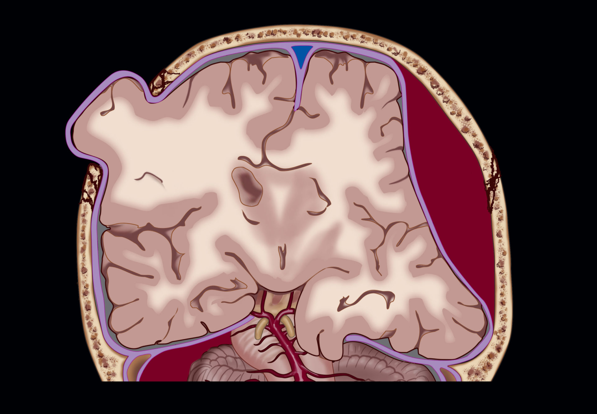 Overview of Brain Herniation Types - MRI Online is now Medality