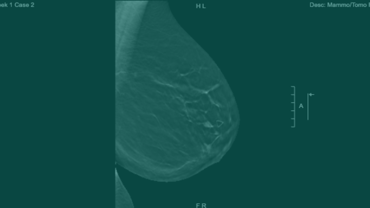 How to Read a Screening Mammogram - MRI Online is now Medality