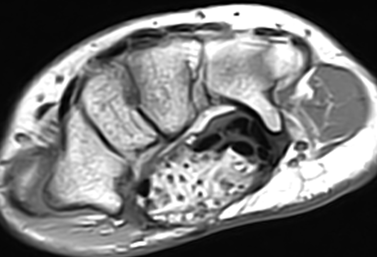 Smooth Muscle, Skeletal Muscle & Pericytic Lesions - Medality / MRI Online